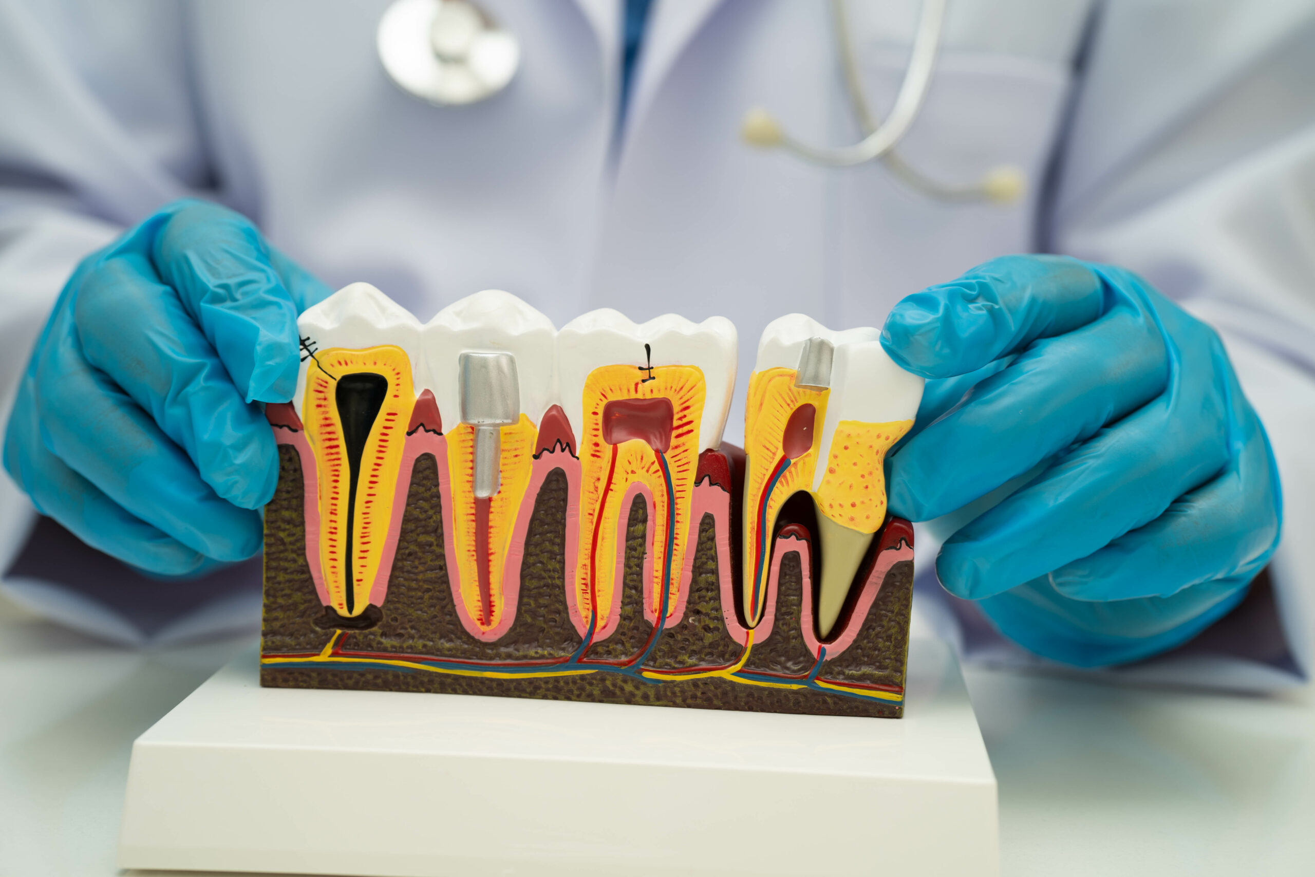 How An Apicoectomy Keeps Smiles Whole - Londonderry, NH